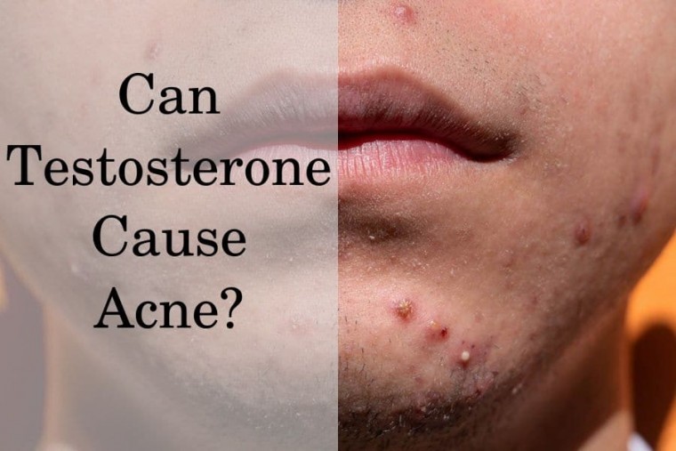 Is Testosterone a Cause of Your Acne? - HRTGuru