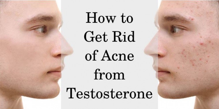 Is Testosterone a Cause of Your Acne? - HRTGuru