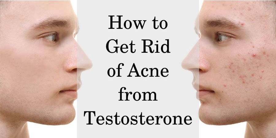 Is Testosterone a Cause of Your Acne? - HRTGuru